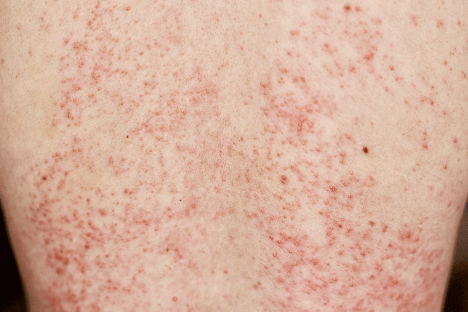 Other Rashes - Cathedral Dermatology