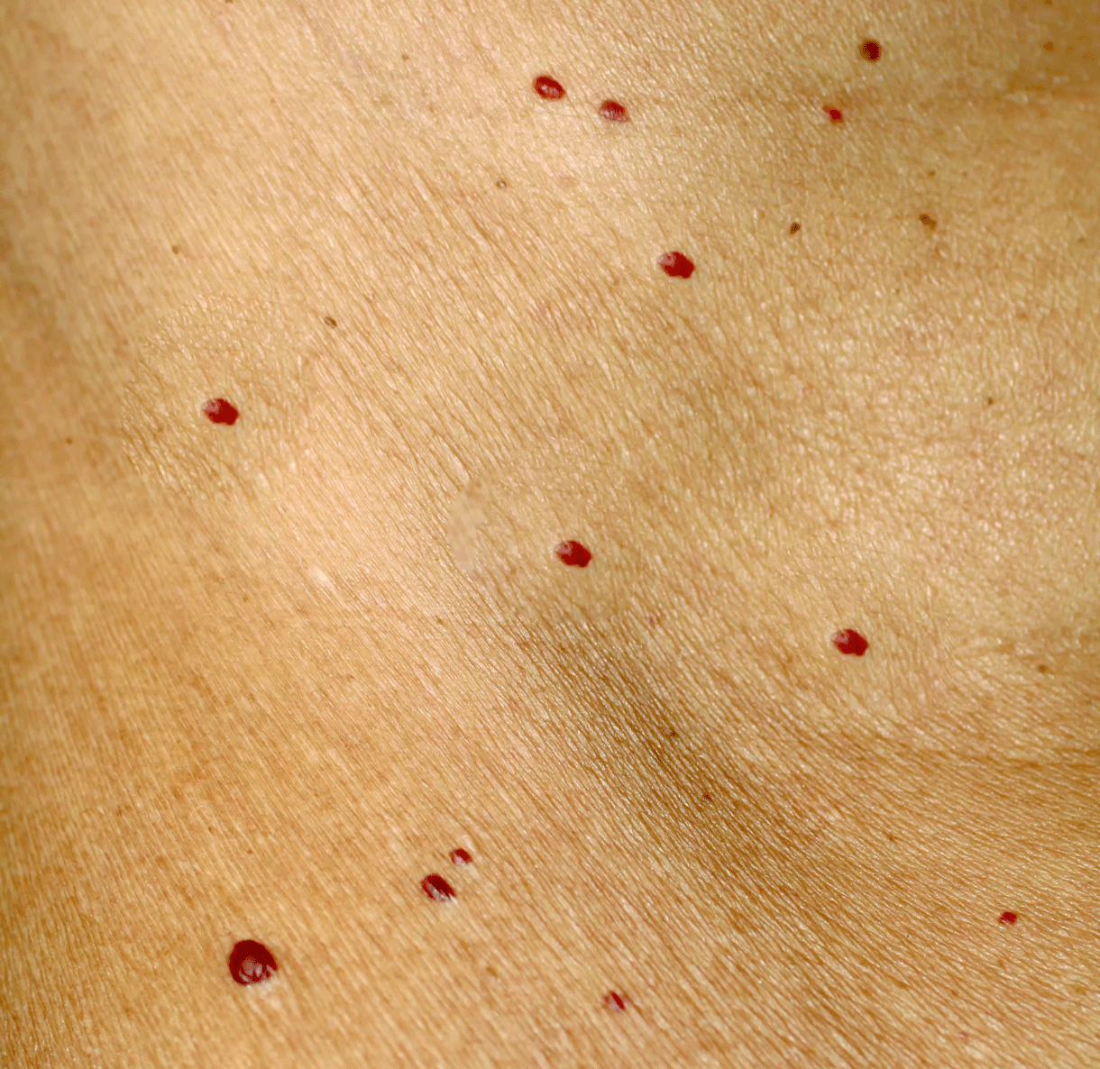 Vascular Lesions - Cathedral Dermatology